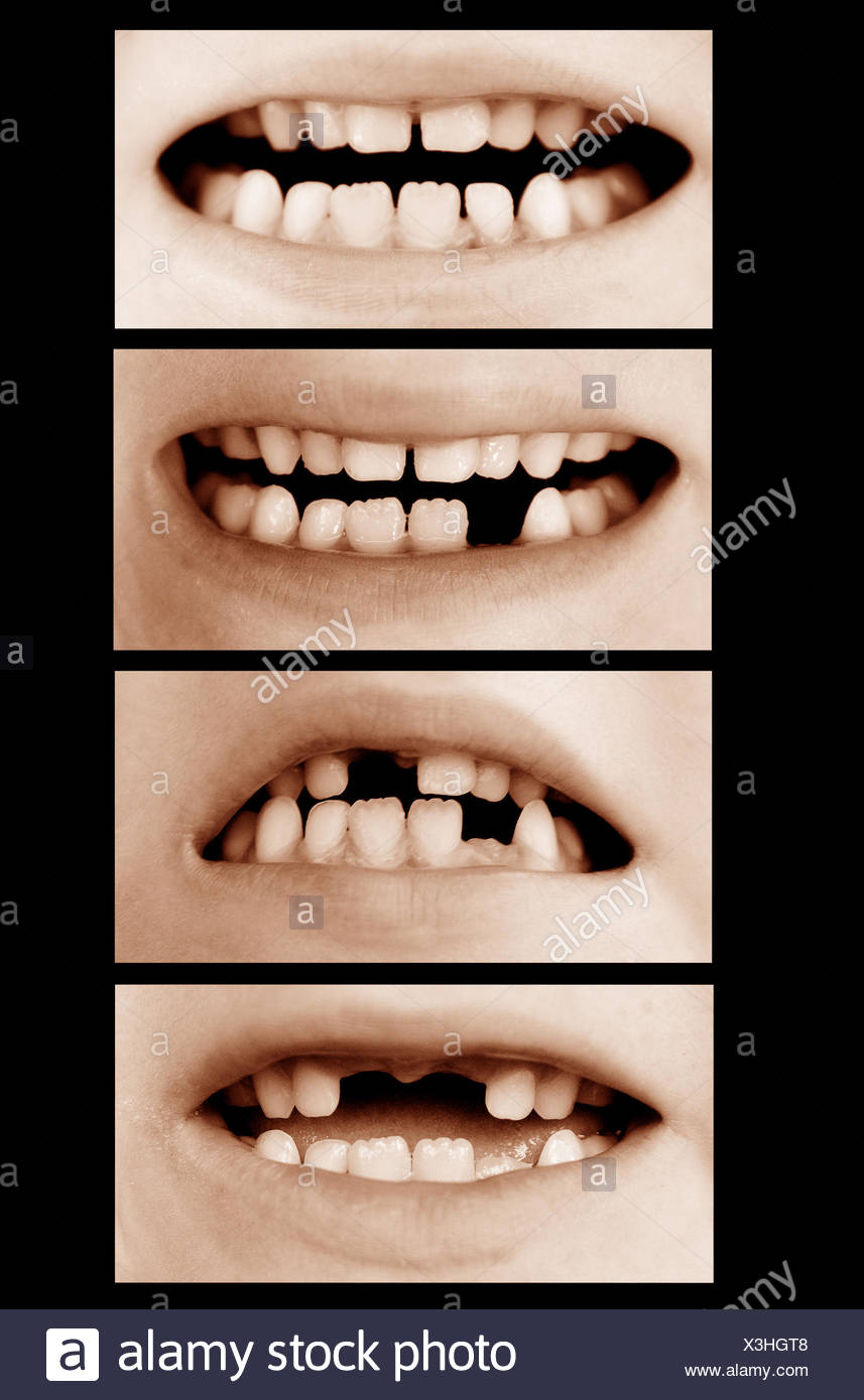 Milk Teeth High Resolution Stock Photography and Images - Alamy