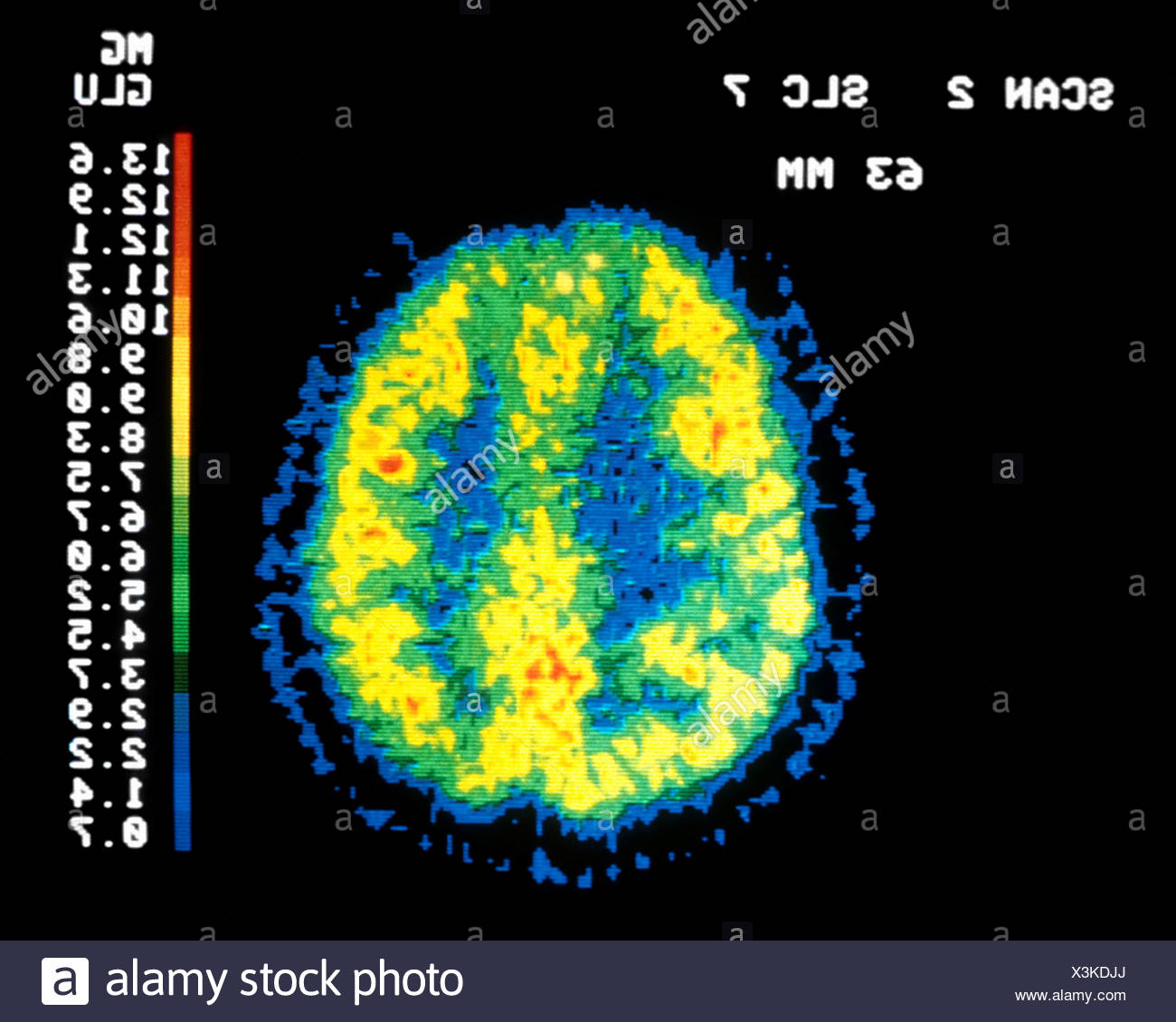 Cerebral Glucose Utilization High Resolution Stock Photography and ...