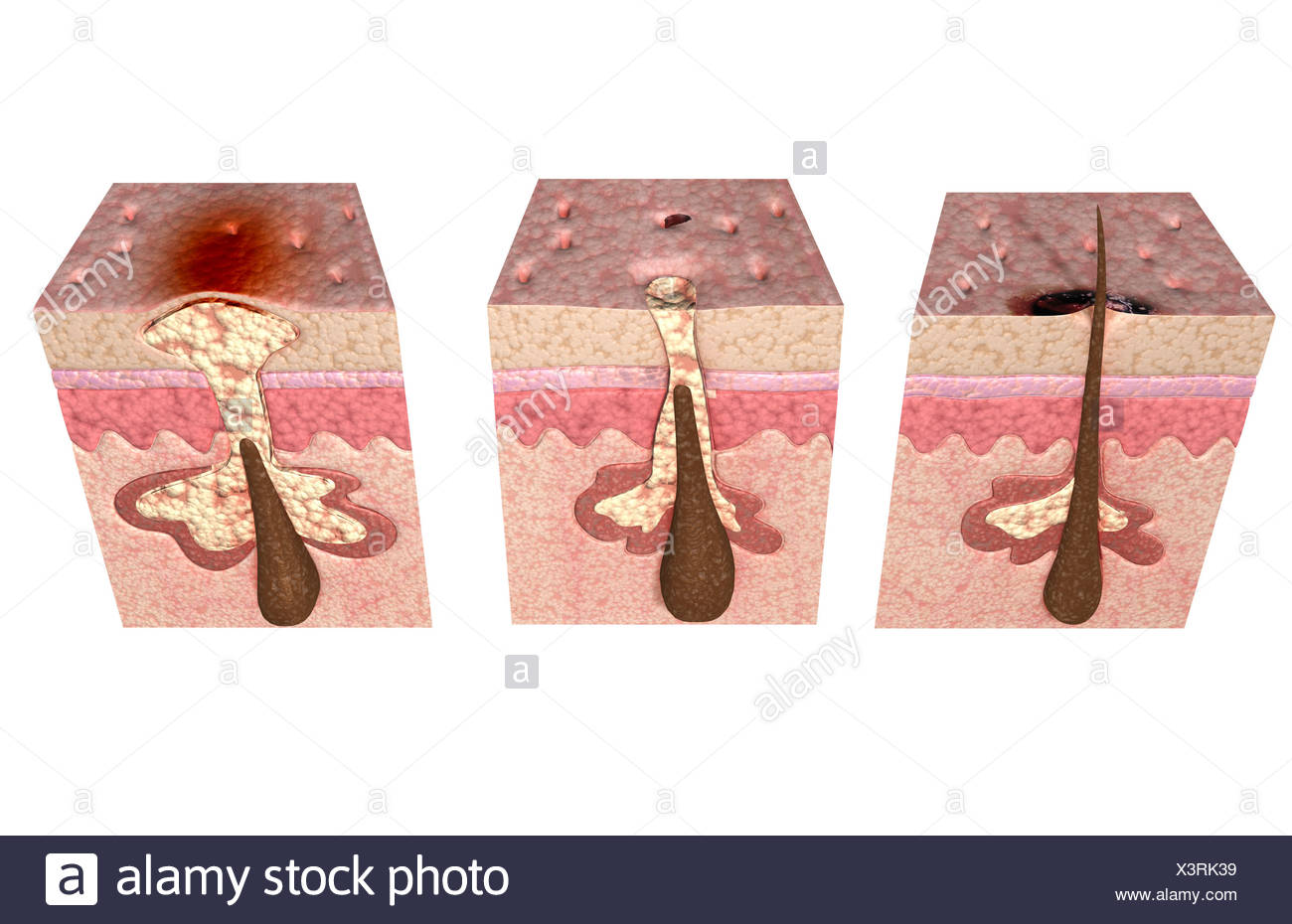 Sebum High Resolution Stock Photography and Images - Alamy