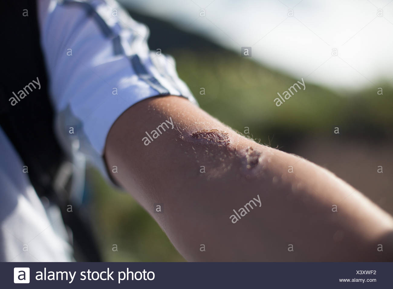 Hand Accident Stock Photos & Hand Accident Stock Images - Alamy