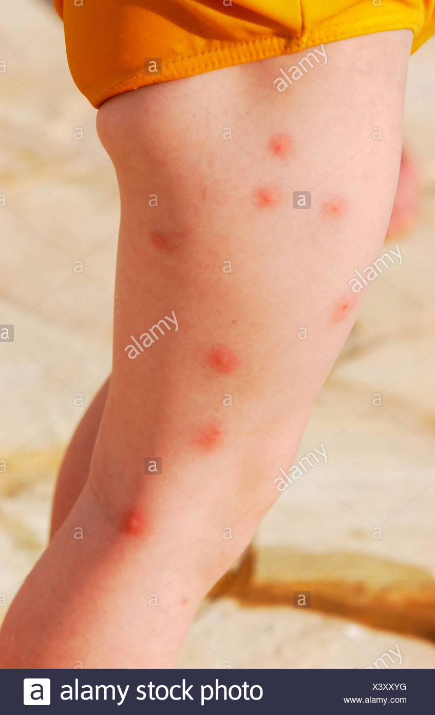 Mosquito Bites Leg High Resolution Stock Photography and Images - Alamy