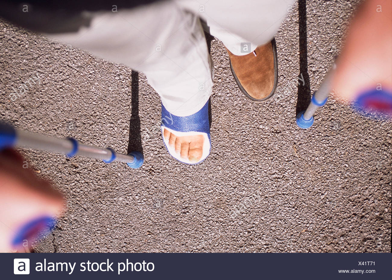Leg In Plaster High Resolution Stock Photography and Images - Alamy