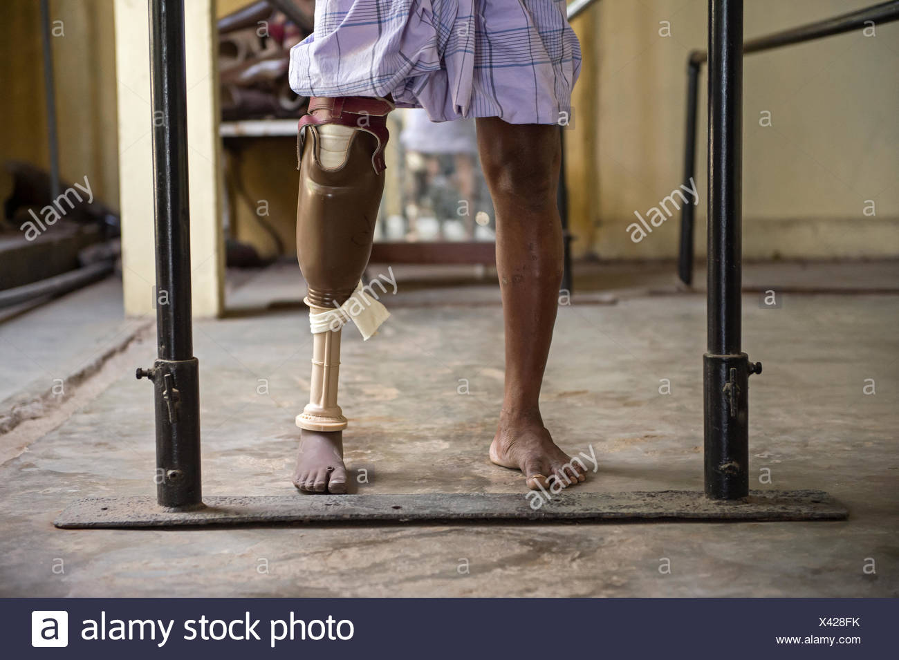 Amputated Leg High Resolution Stock Photography and Images - Alamy