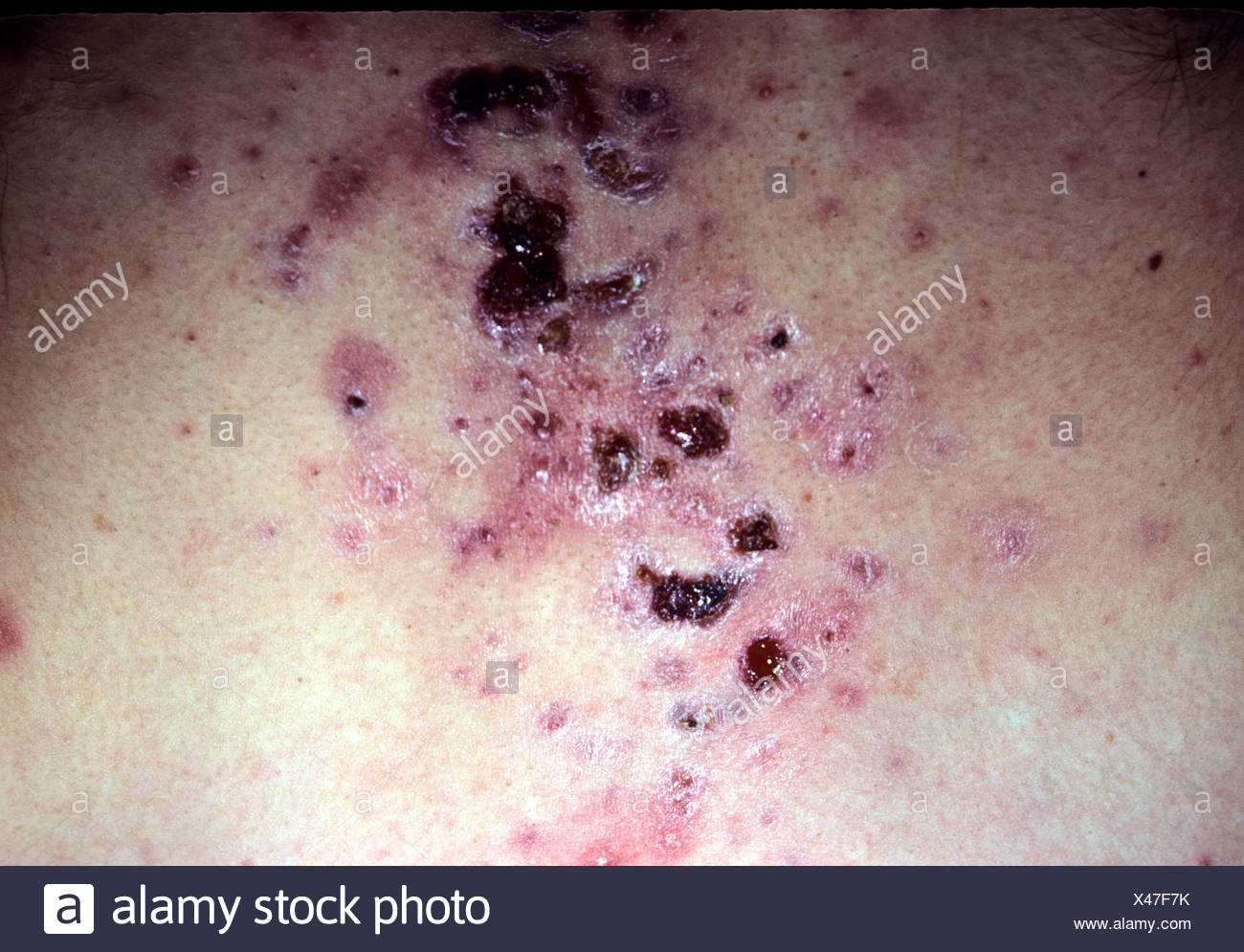 Comedones High Resolution Stock Photography and Images - Alamy