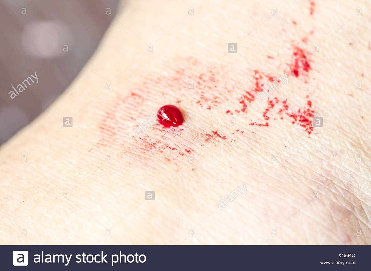 Wound Care Nurse Stock Photos & Wound Care Nurse Stock Images - Alamy