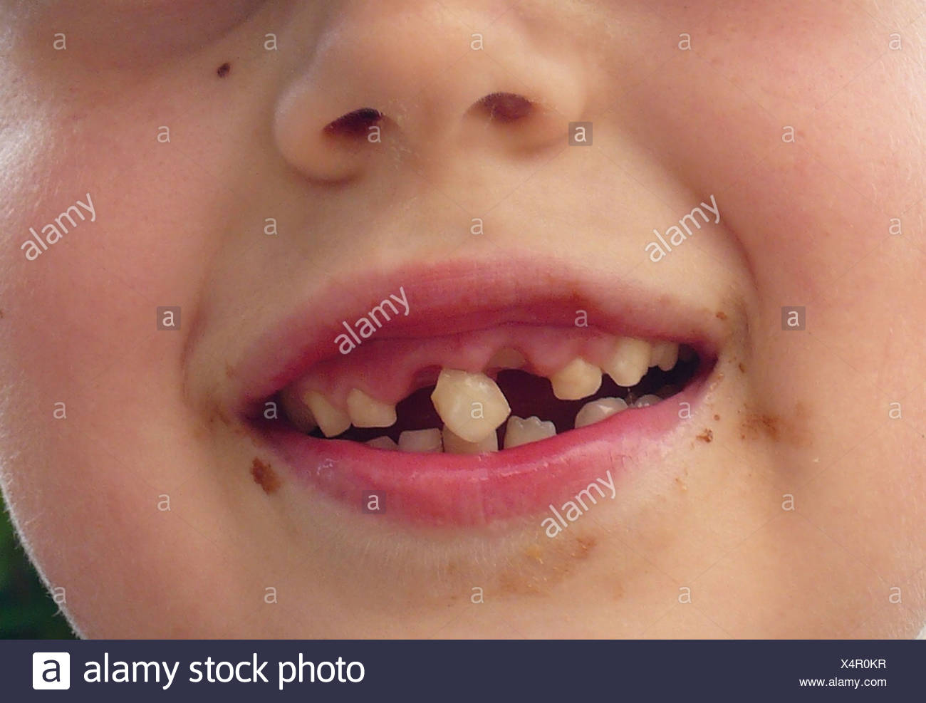 Wobbly Tooth High Resolution Stock Photography and Images - Alamy