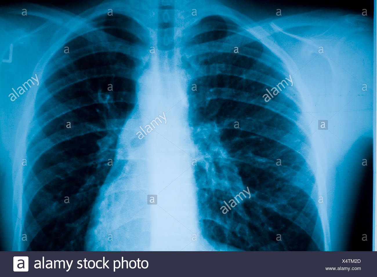 Thorax High Resolution Stock Photography and Images - Alamy