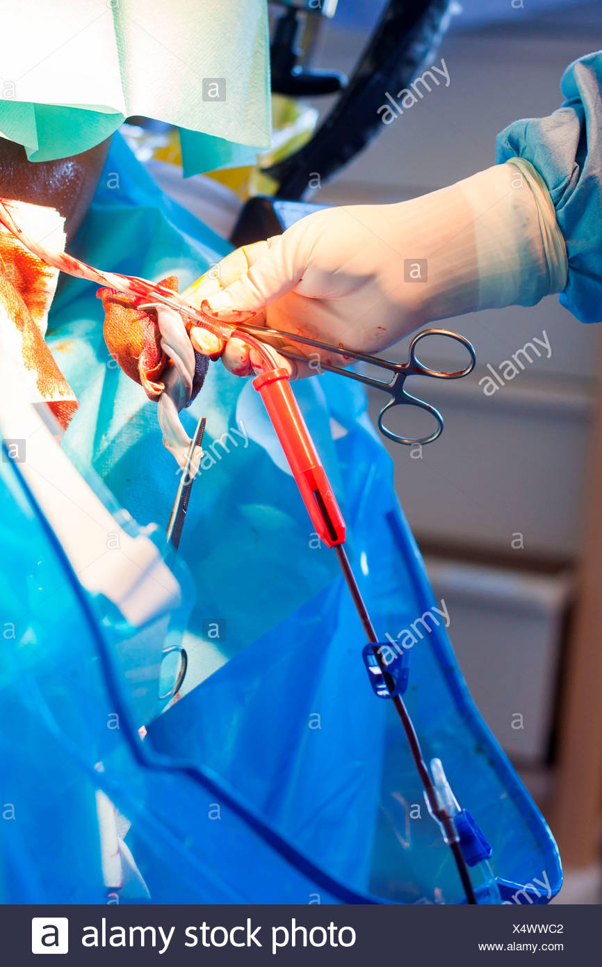 Blood Stem Cell Harvesting High Resolution Stock Photography and Images ...