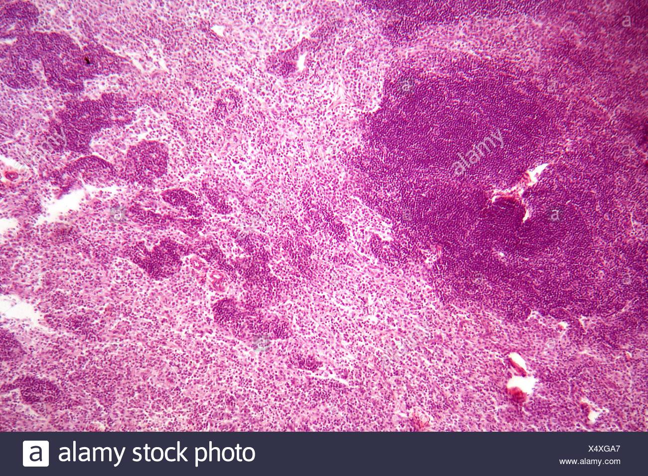 Lymph Node Micrograph High Resolution Stock Photography and Images - Alamy