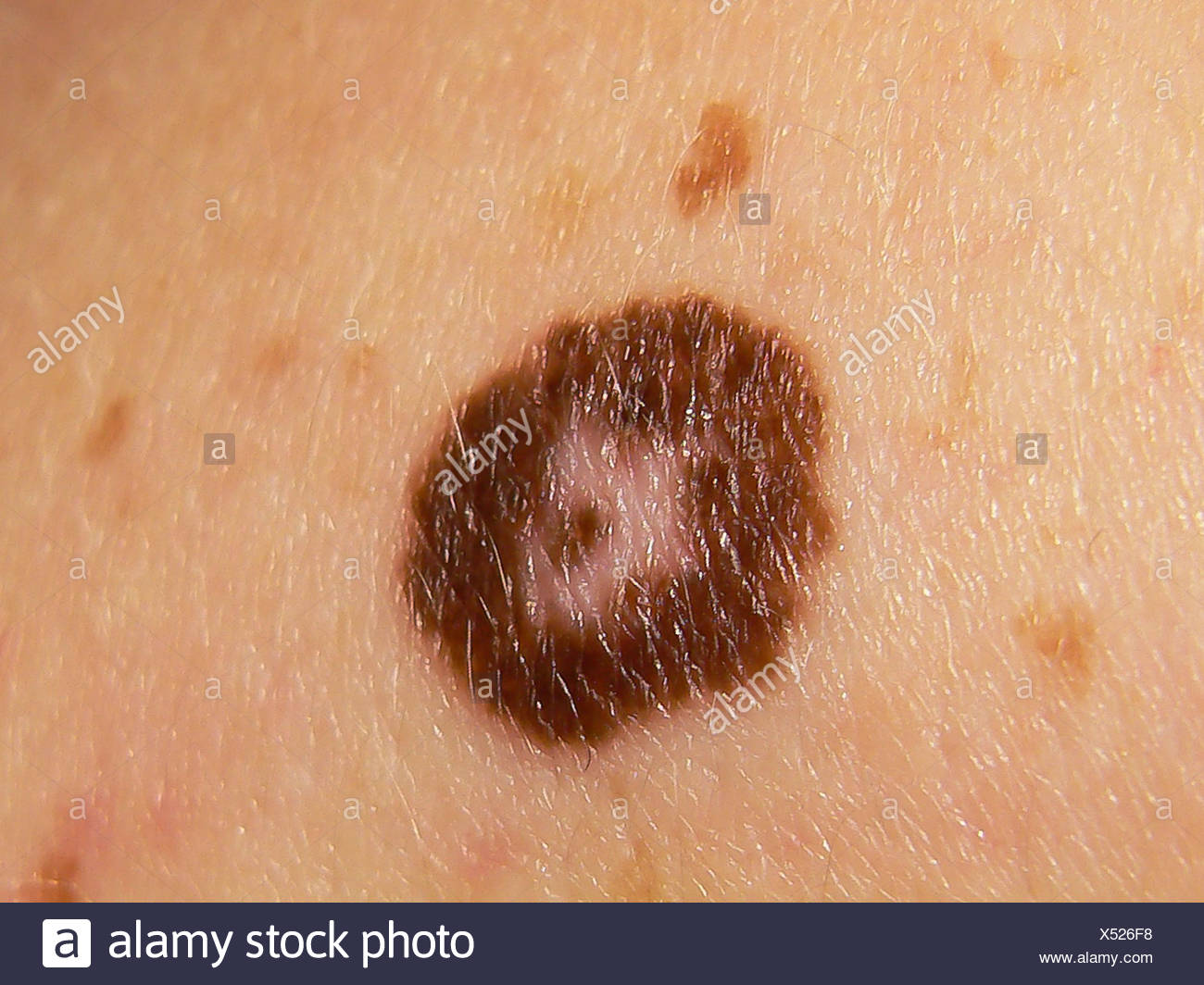 Dysplastic Nevi High Resolution Stock Photography and Images - Alamy