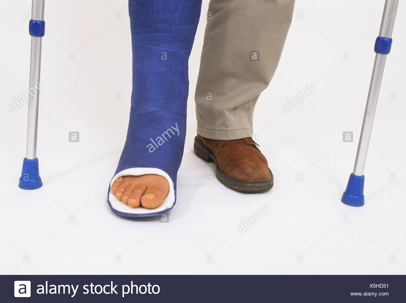 Plaster Cast Leg Stock Photos & Plaster Cast Leg Stock Images - Alamy
