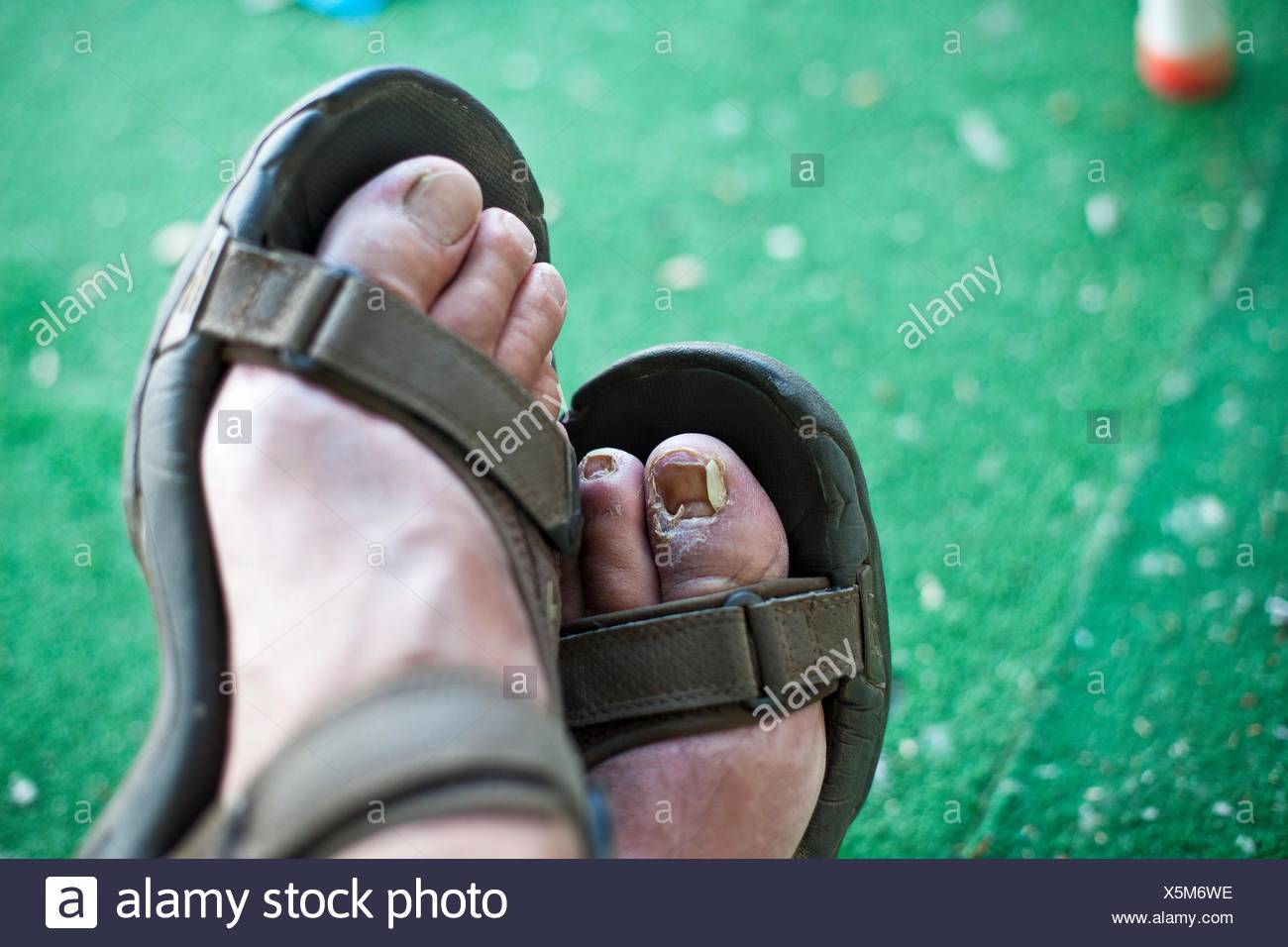 Missing Toe High Resolution Stock Photography and Images - Alamy