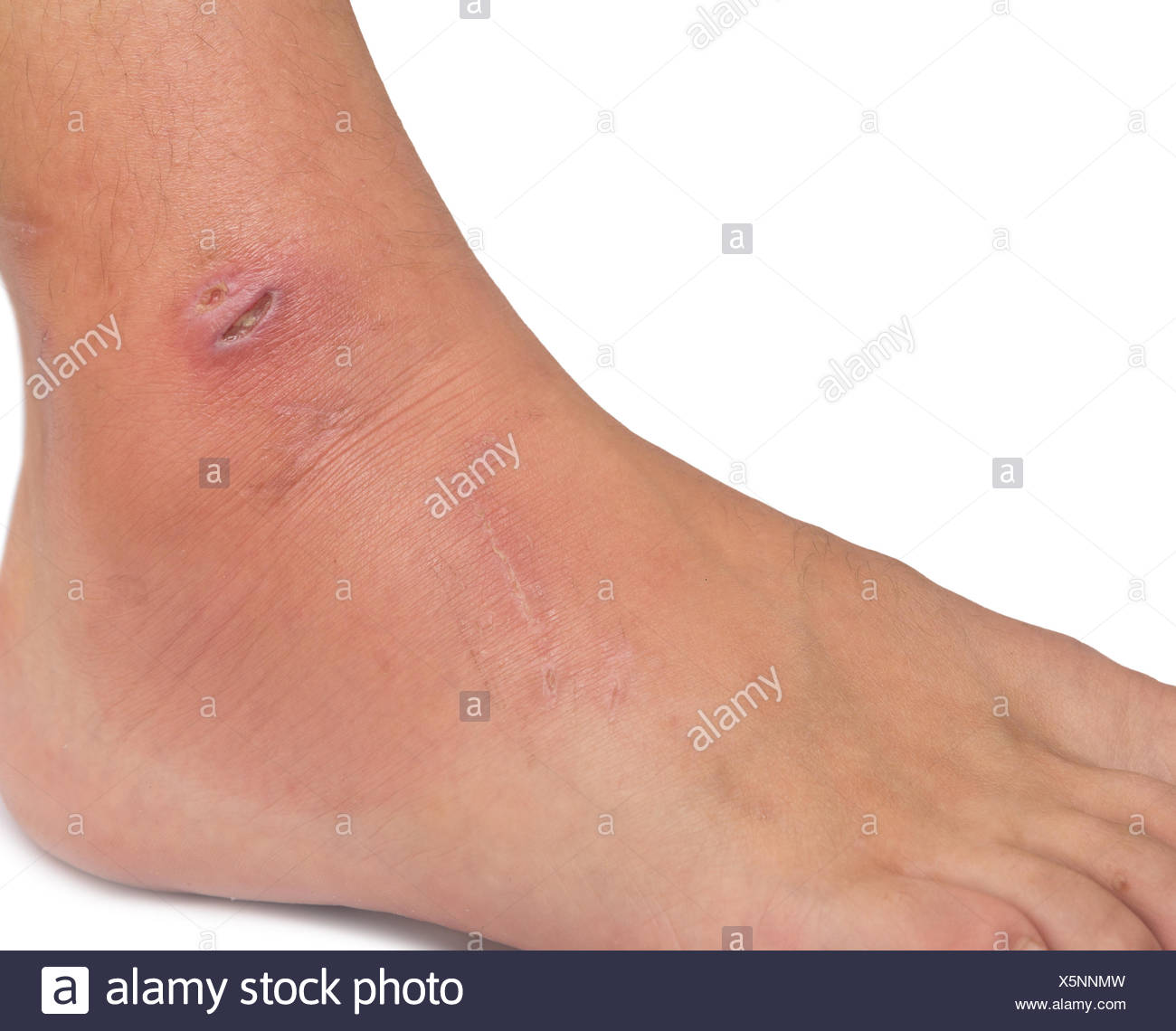 Pus Wound Stock Photos & Pus Wound Stock Images - Alamy