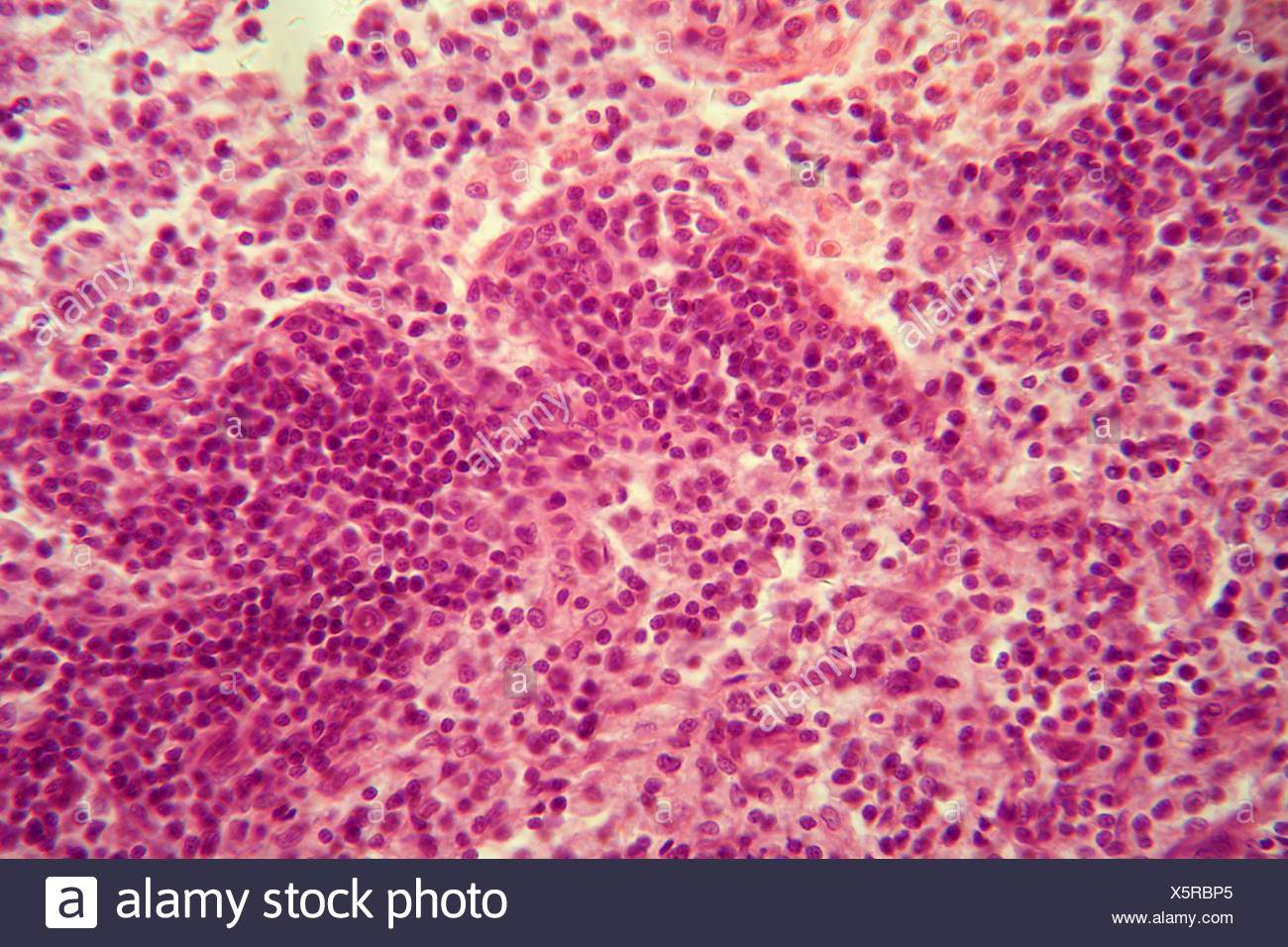 Lymph Node Micrograph High Resolution Stock Photography and Images - Alamy