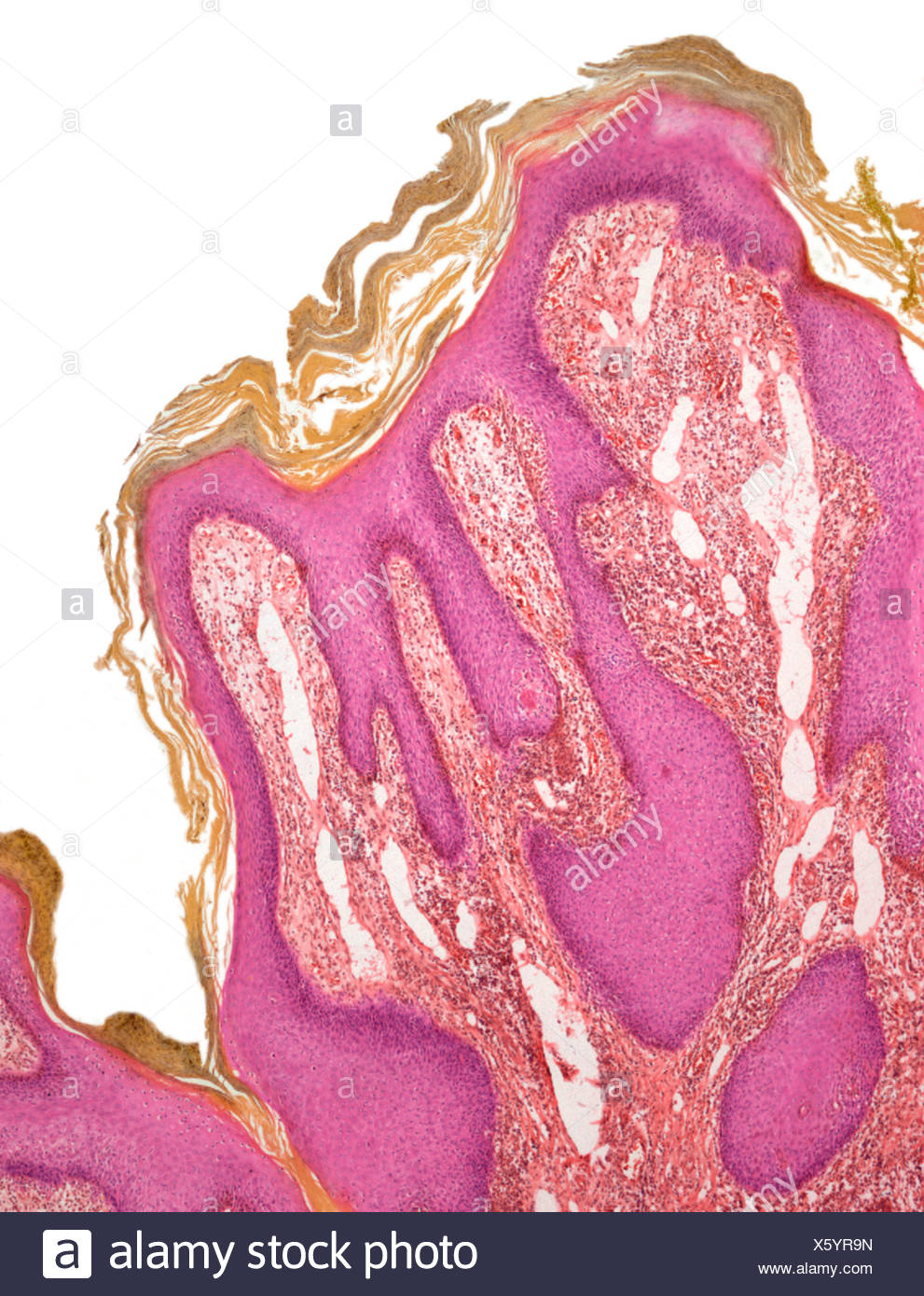 Hyperkeratosis Stock Photos & Hyperkeratosis Stock Images - Alamy