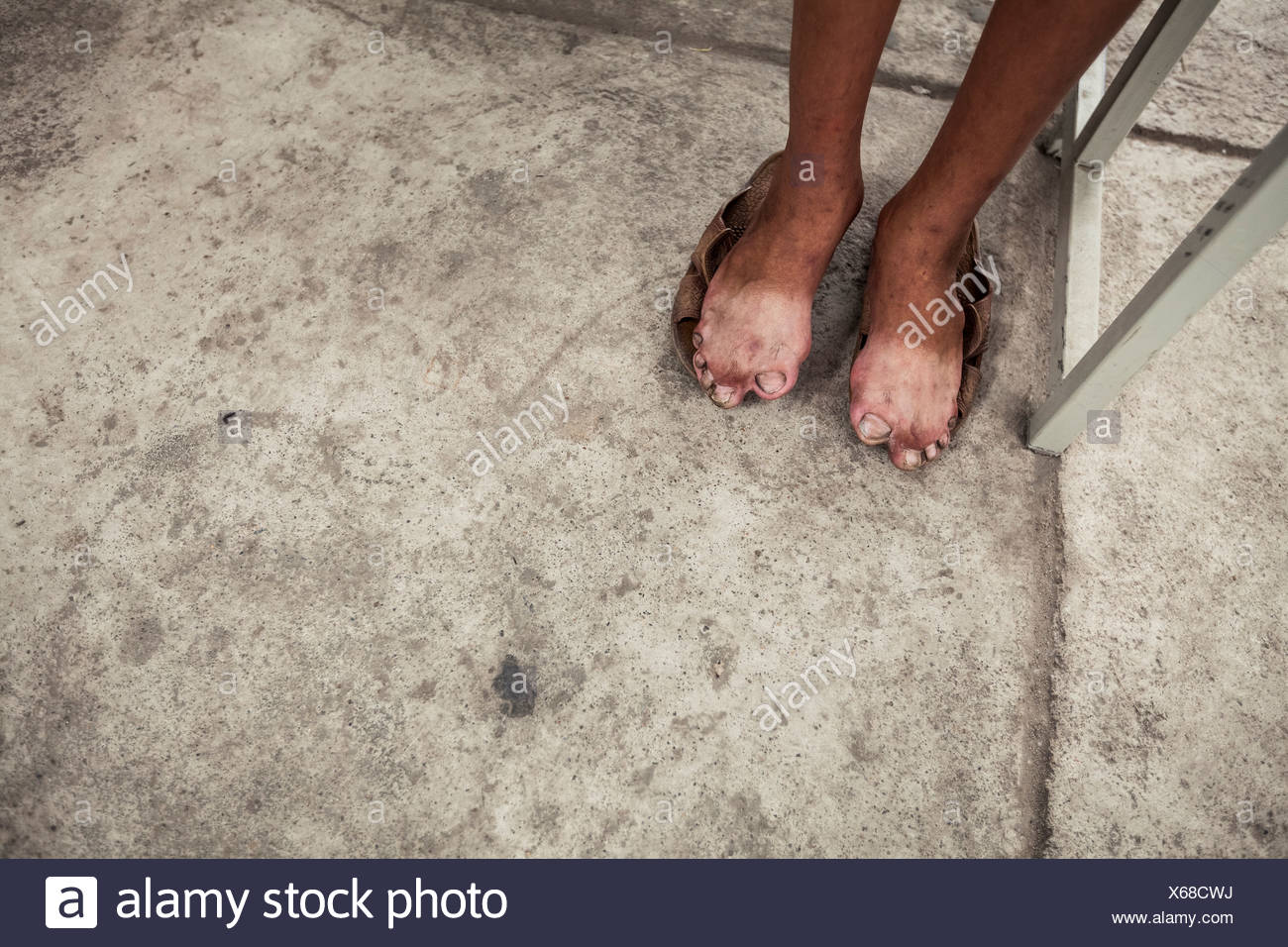 Deformed Feet High Resolution Stock Photography and Images - Alamy