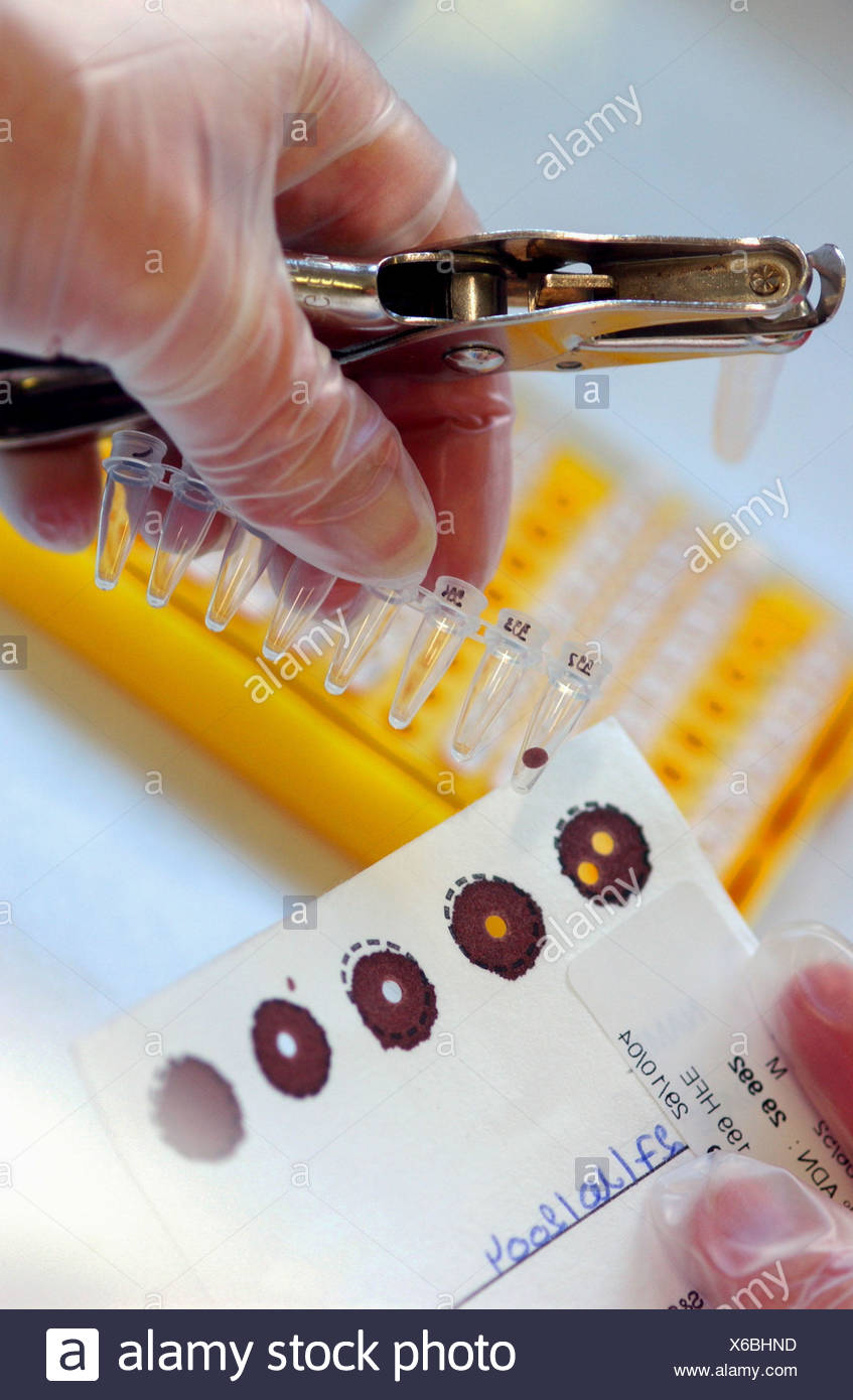 Hemochromatosis Stock Photos & Hemochromatosis Stock Images - Alamy