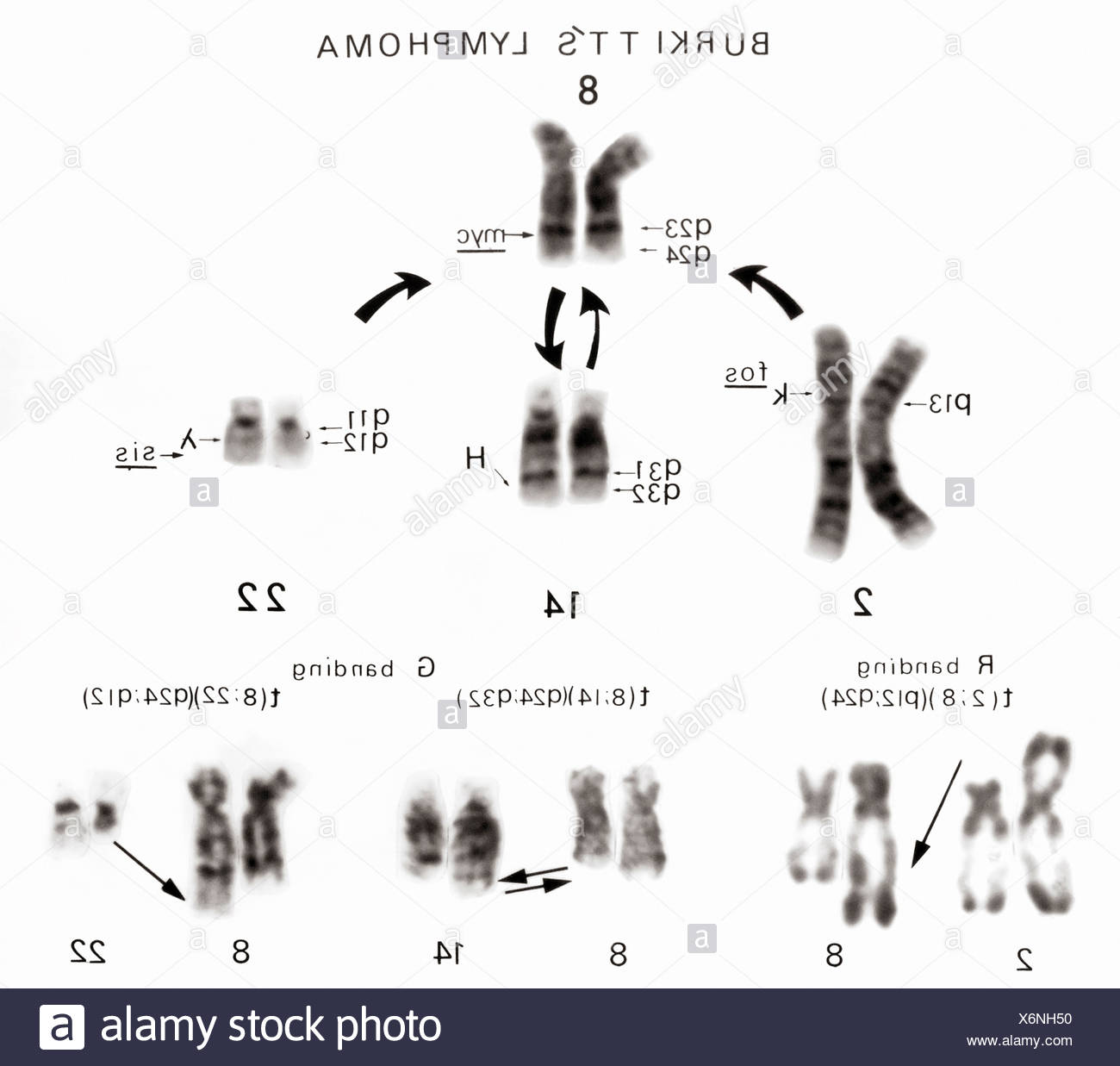 Burkitts Lymphoma High Resolution Stock Photography and Images - Alamy