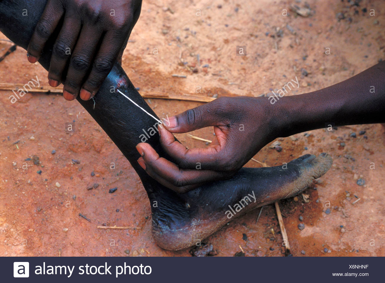 Guinea Worm Disease Stock Photos & Guinea Worm Disease Stock Images - Alamy