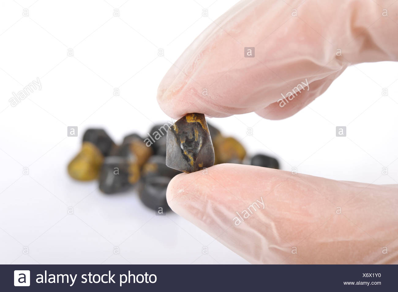 Gall Stone Stock Photos & Gall Stone Stock Images - Alamy