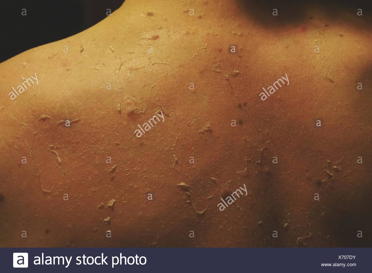 Skin Burnt High Resolution Stock Photography and Images - Alamy