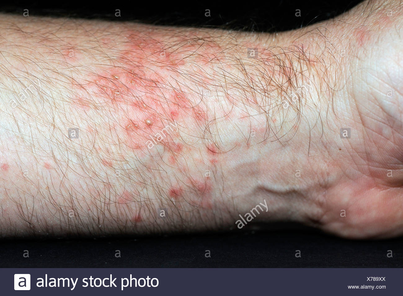 Hives Human Stock Photos & Hives Human Stock Images - Alamy