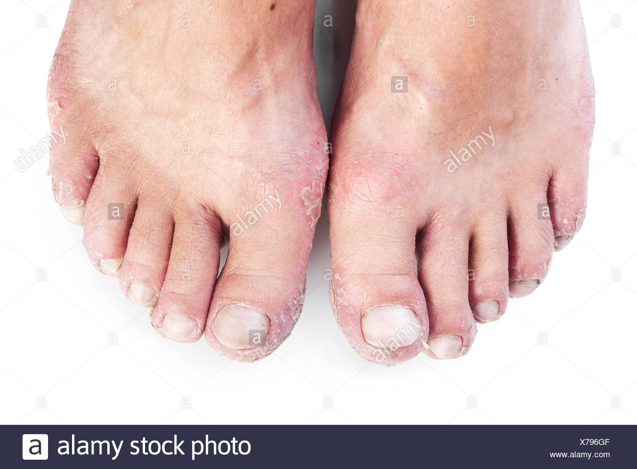 Psoriasis Foot Stock Photos & Psoriasis Foot Stock Images - Alamy