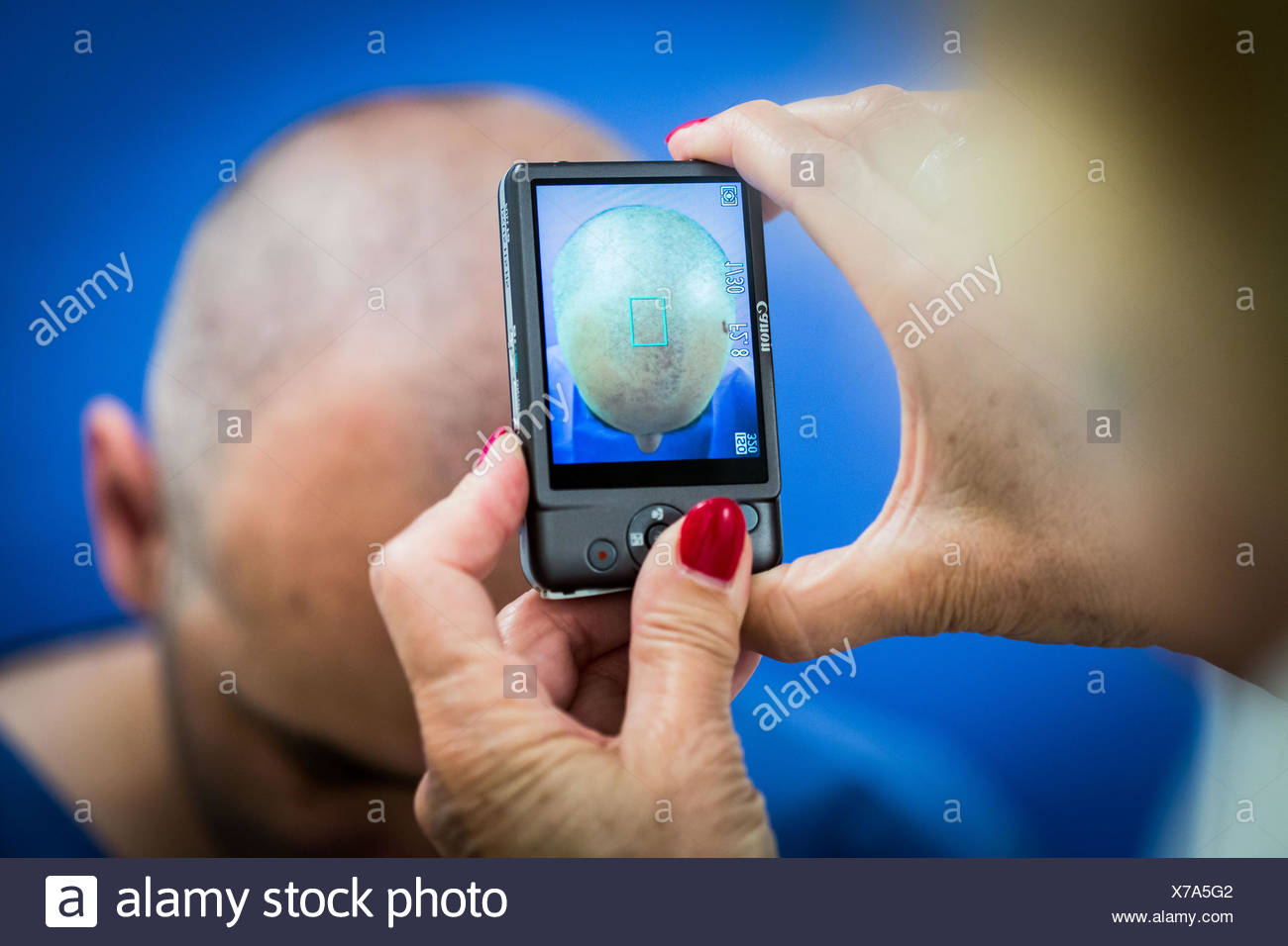 Follicle Procedure High Resolution Stock Photography and Images - Alamy