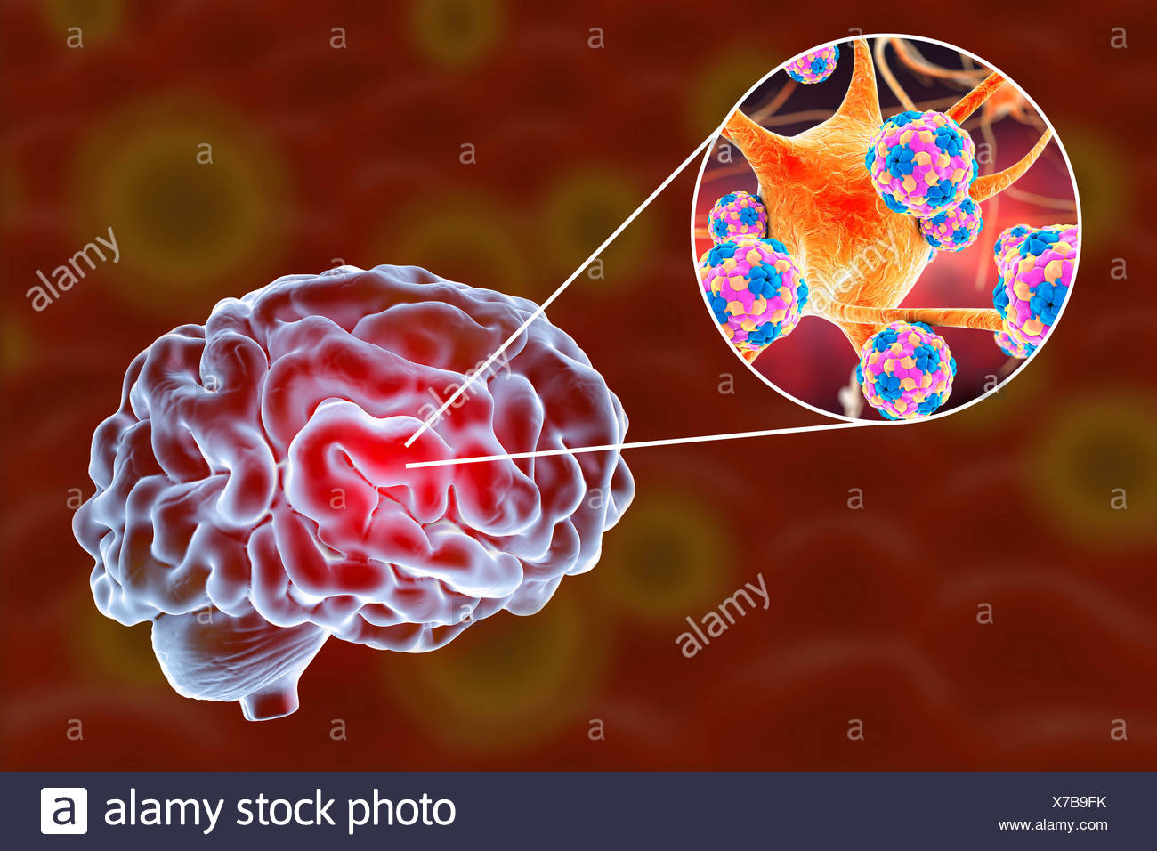 Meningitis Brain High Resolution Stock Photography and Images - Alamy