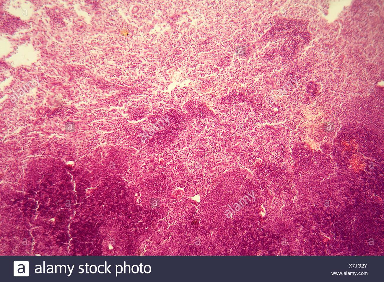 Lymph Cancer High Resolution Stock Photography and Images - Alamy
