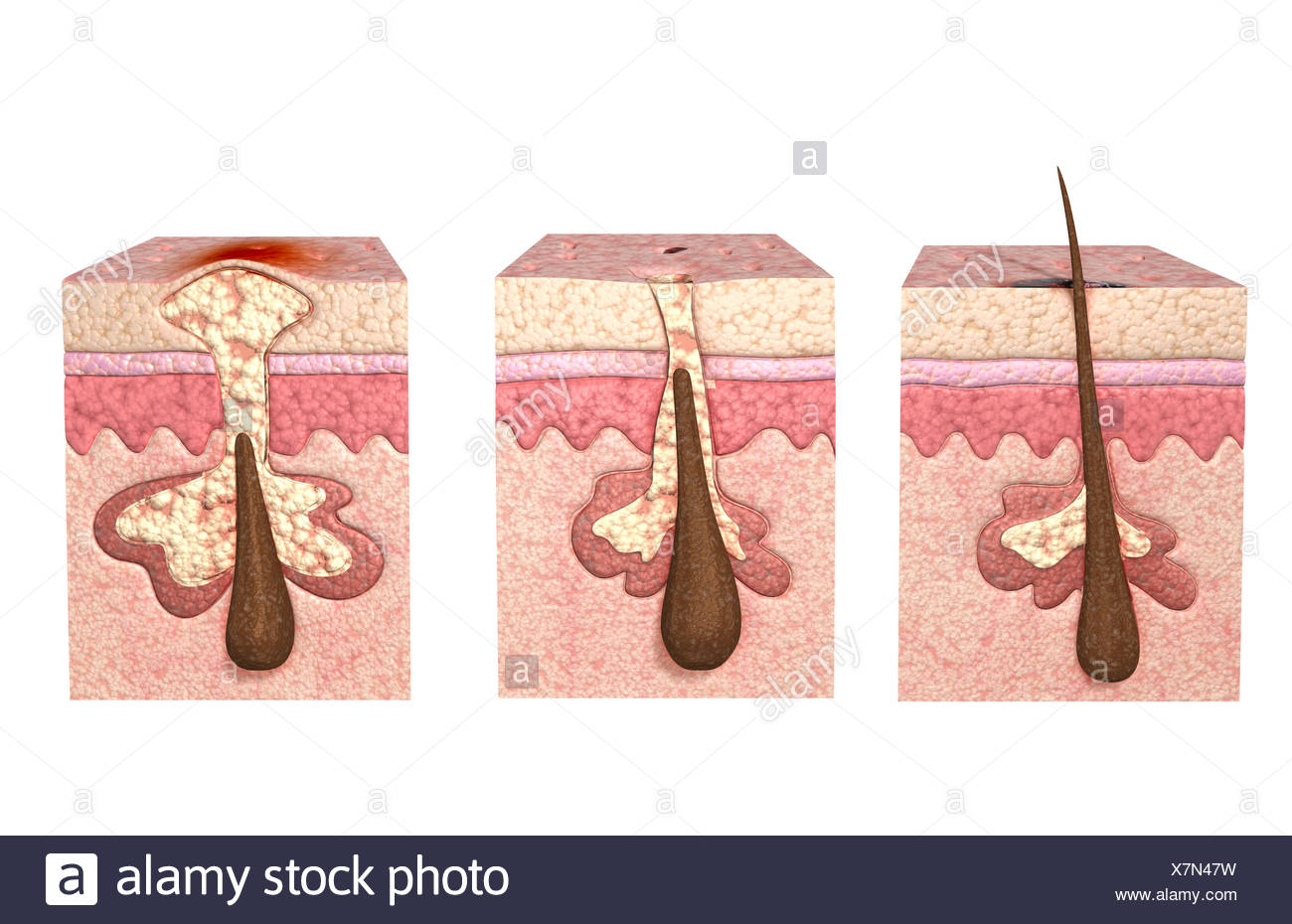 Sebum High Resolution Stock Photography and Images - Alamy