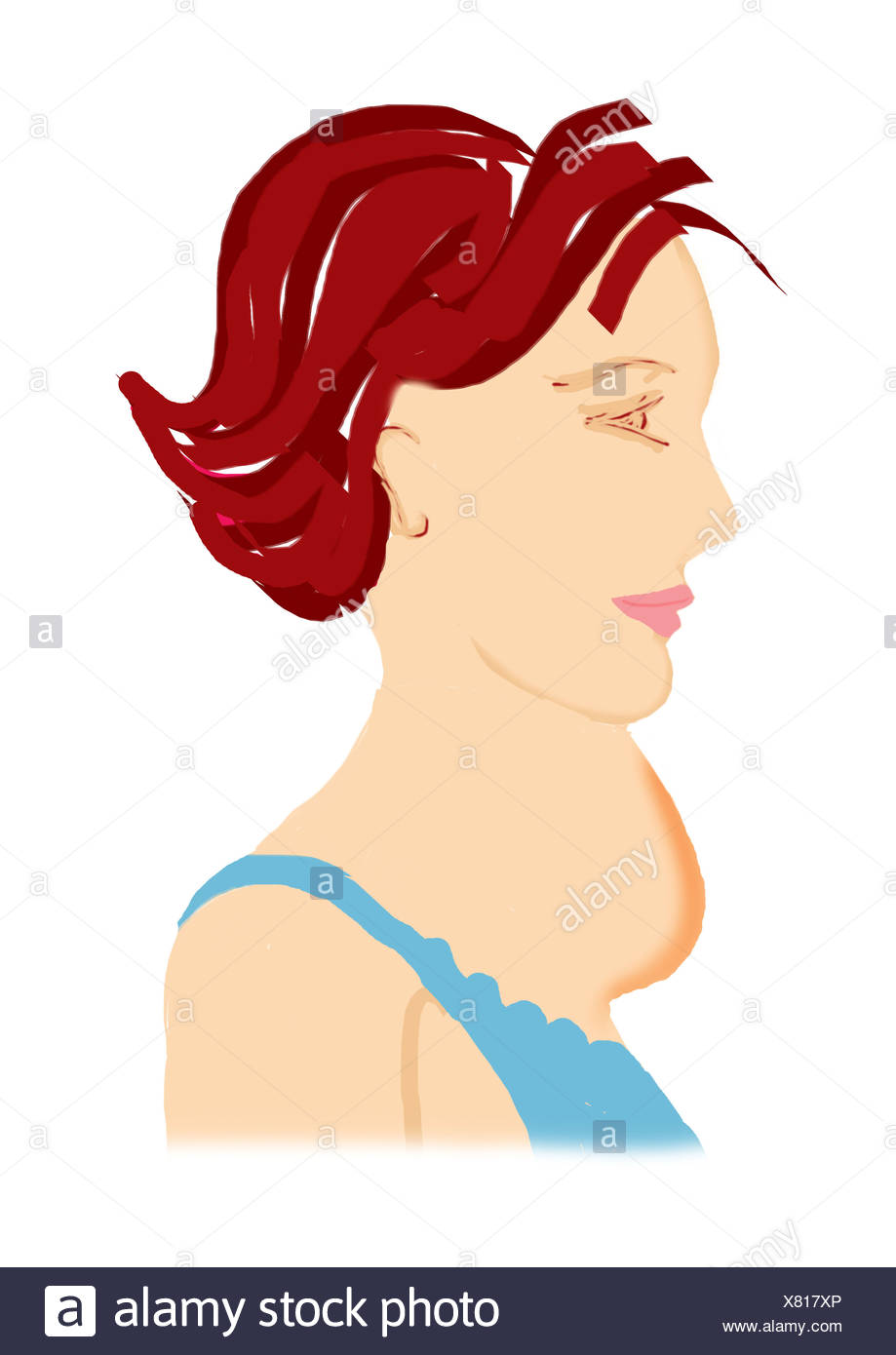 Goitre Thyroid Stock Photos & Goitre Thyroid Stock Images - Alamy