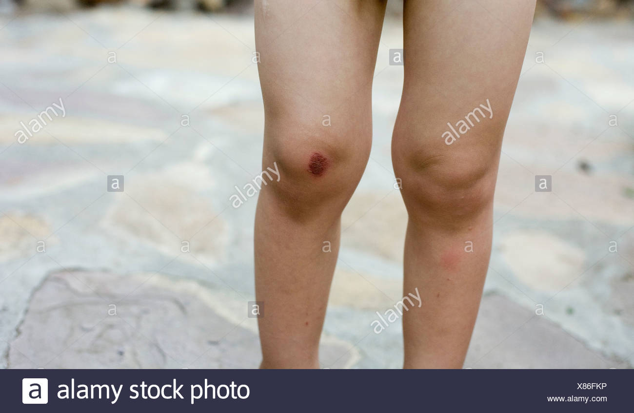 Grazed Injury High Resolution Stock Photography and Images - Alamy