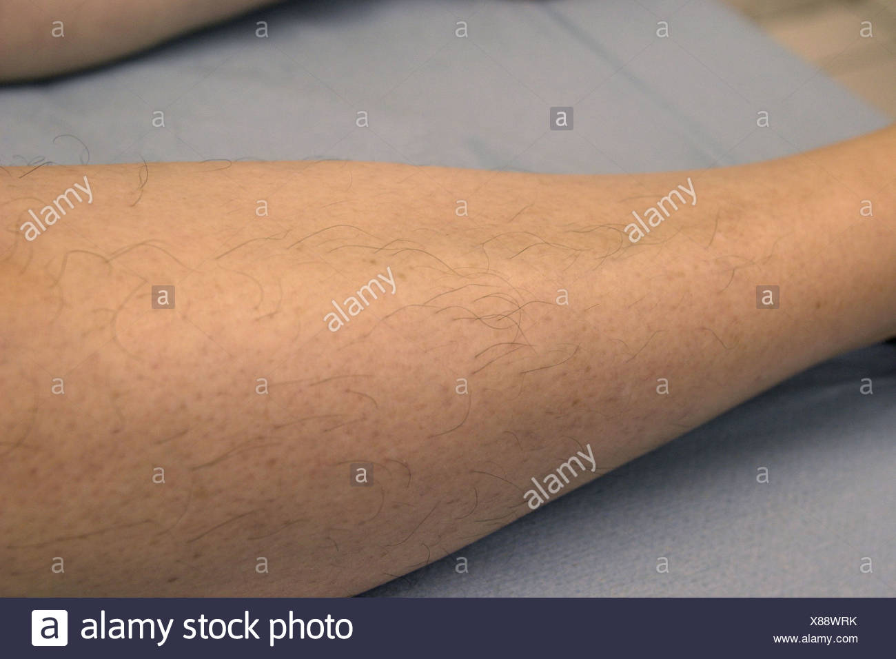 Hirsutism High Resolution Stock Photography and Images - Alamy