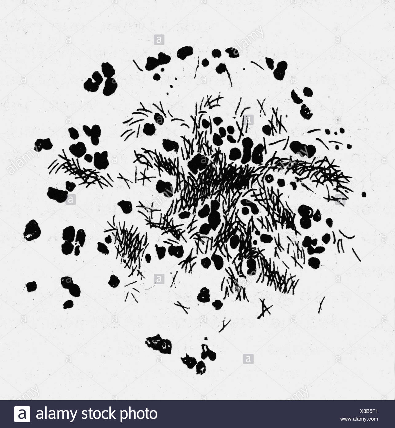 Tuberculosis Drawing Black and White Stock Photos & Images - Alamy