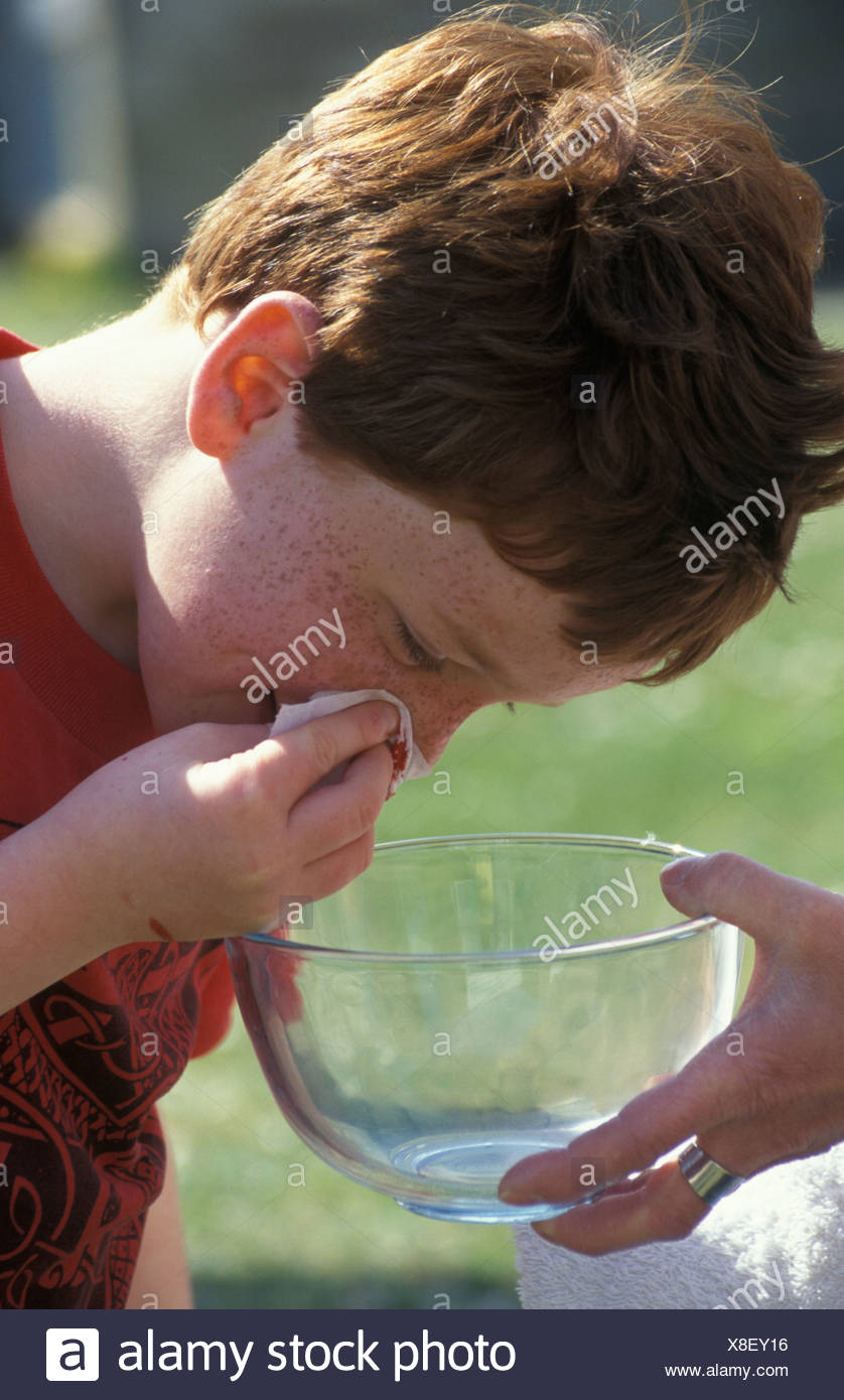 Bleeding Nose Stock Photos & Bleeding Nose Stock Images - Alamy