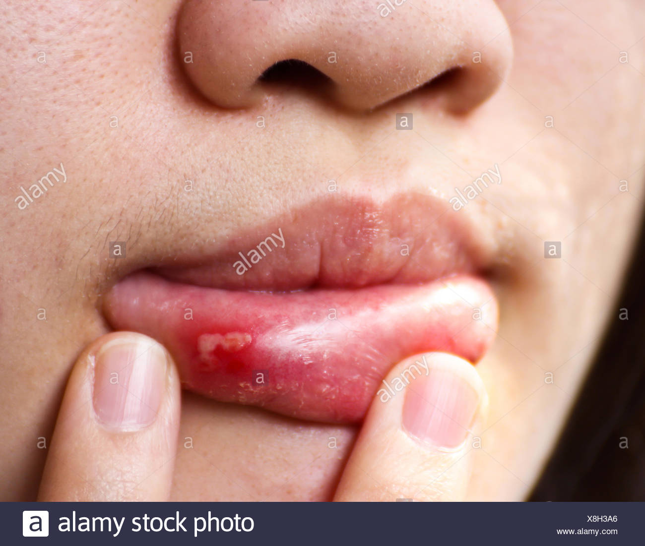 Mouth Ulcer High Resolution Stock Photography and Images - Alamy