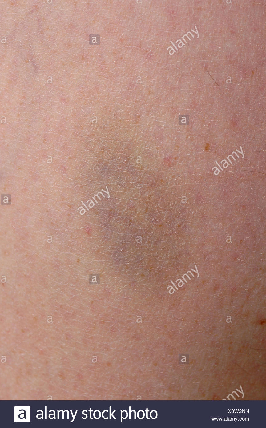 Haematoma High Resolution Stock Photography and Images - Alamy