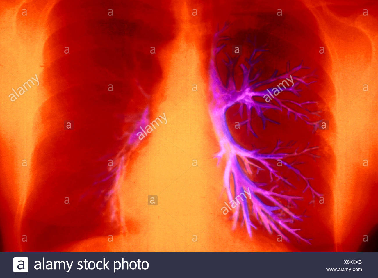 Bronchiectasis Stock Photos & Bronchiectasis Stock Images - Alamy