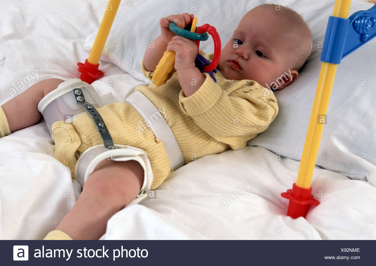 Developmental Dysplasia Of The Hip High Resolution Stock Photography ...