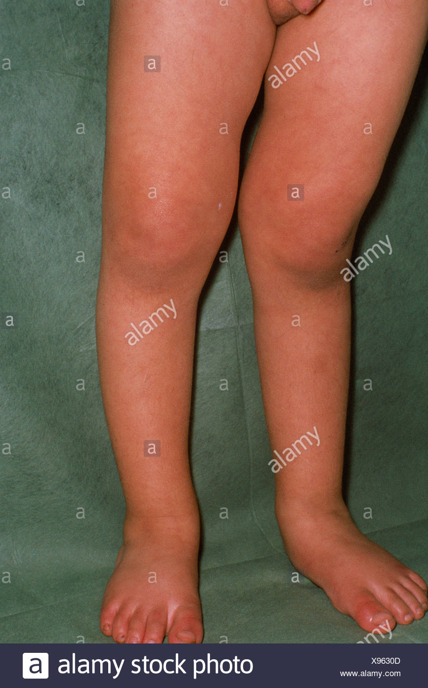 Rickets Child Stock Photos & Rickets Child Stock Images - Alamy