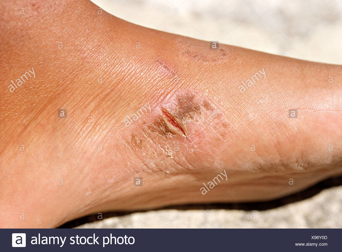 Sores Foot Stock Photos & Sores Foot Stock Images - Alamy