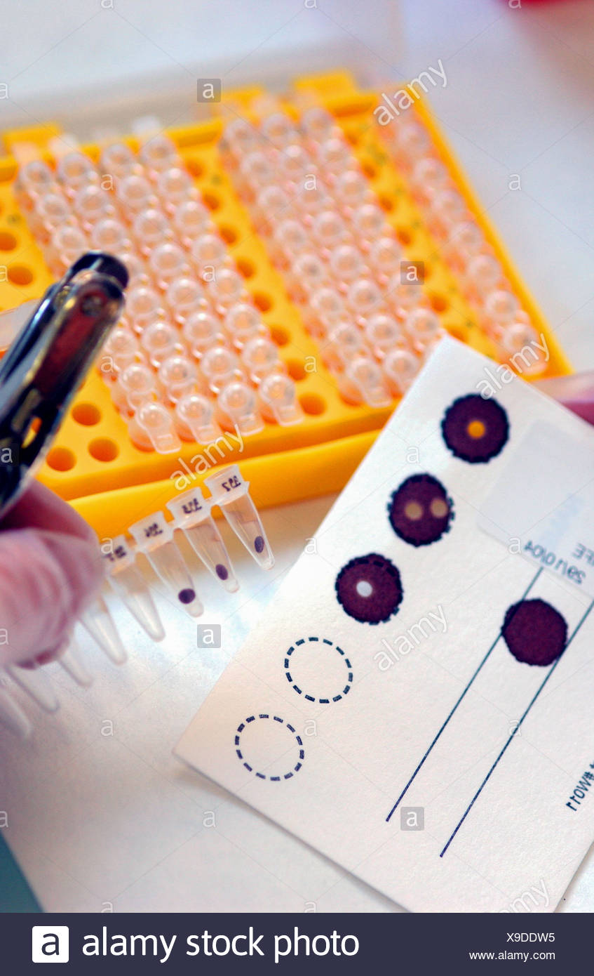 Hemochromatosis Stock Photos & Hemochromatosis Stock Images - Alamy