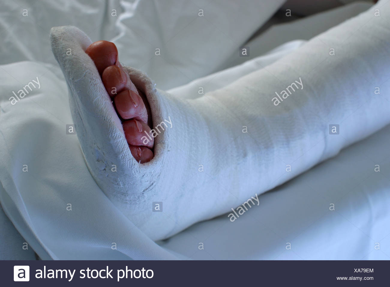 Gipsbein Stock Photos & Gipsbein Stock Images - Alamy