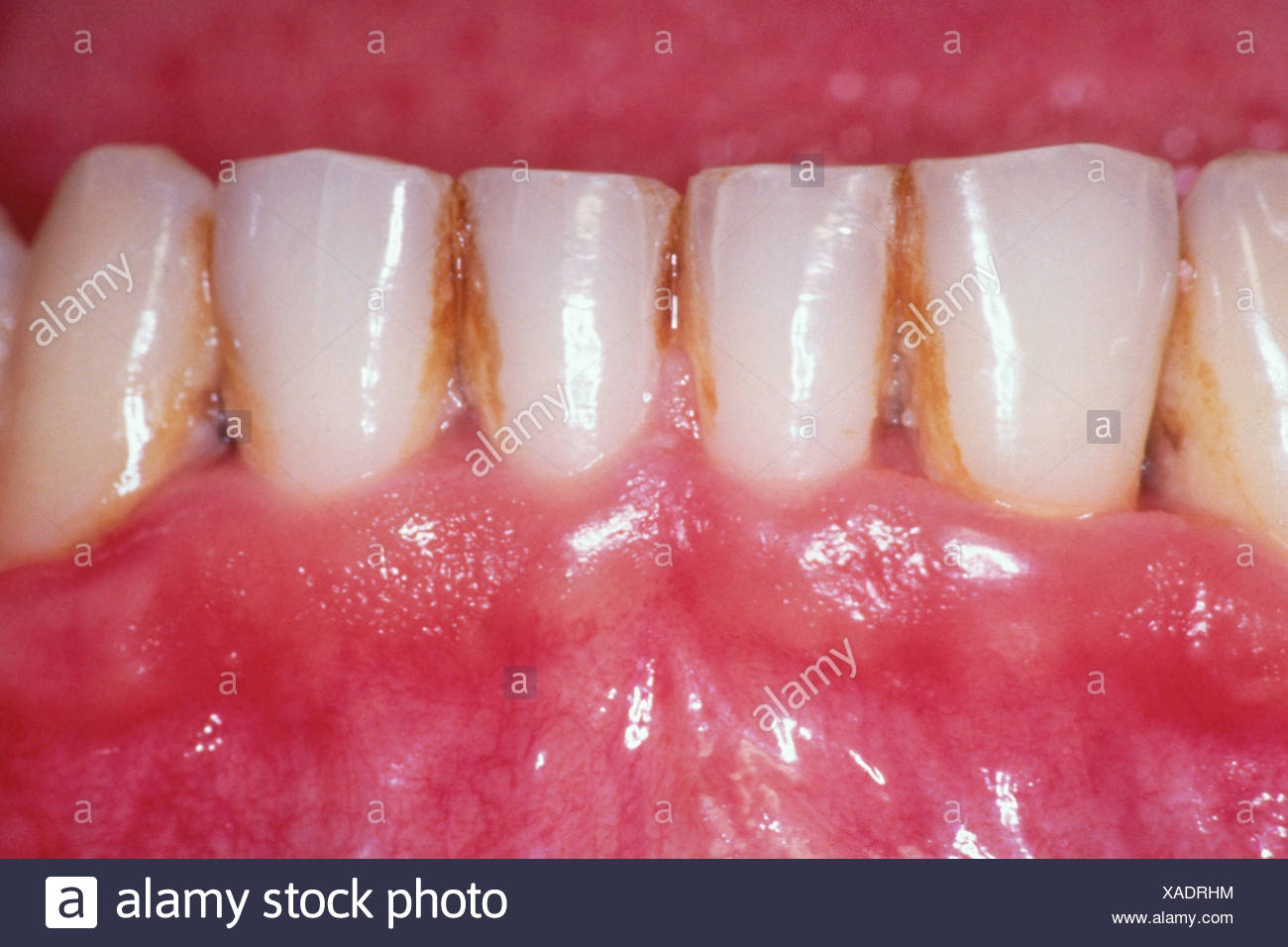 Gingivitis Stock Photos & Gingivitis Stock Images - Alamy