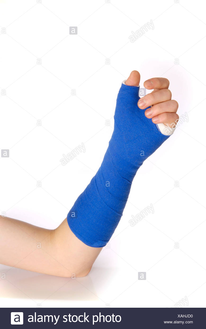 Both Arms Casts High Resolution Stock Photography and Images - Alamy