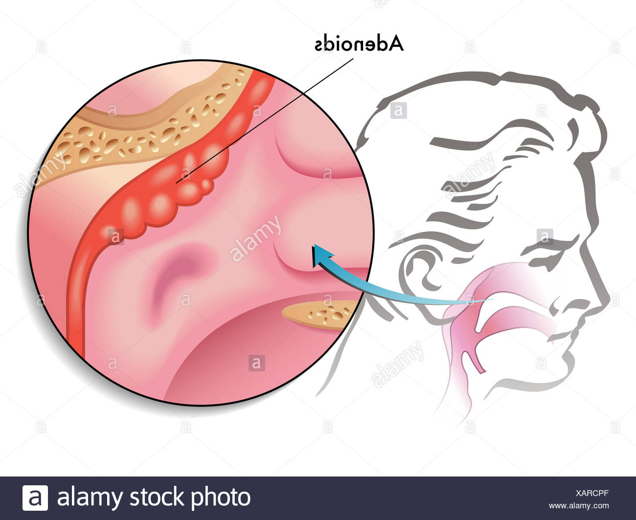 Adenoids Stock Photos & Adenoids Stock Images - Alamy