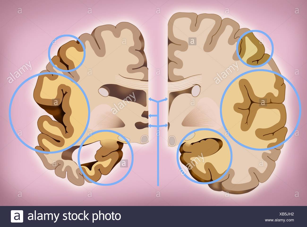 Alzheimers Brain Stock Photos & Alzheimers Brain Stock Images - Alamy