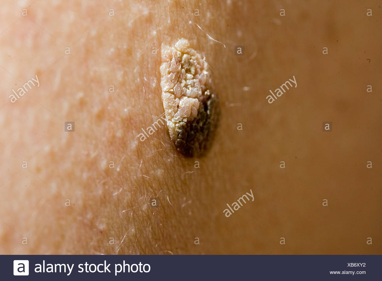 Verruca Stock Photos & Verruca Stock Images - Alamy