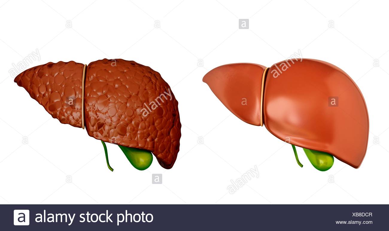 Liver Cirrhosis Stock Photos & Liver Cirrhosis Stock Images - Alamy